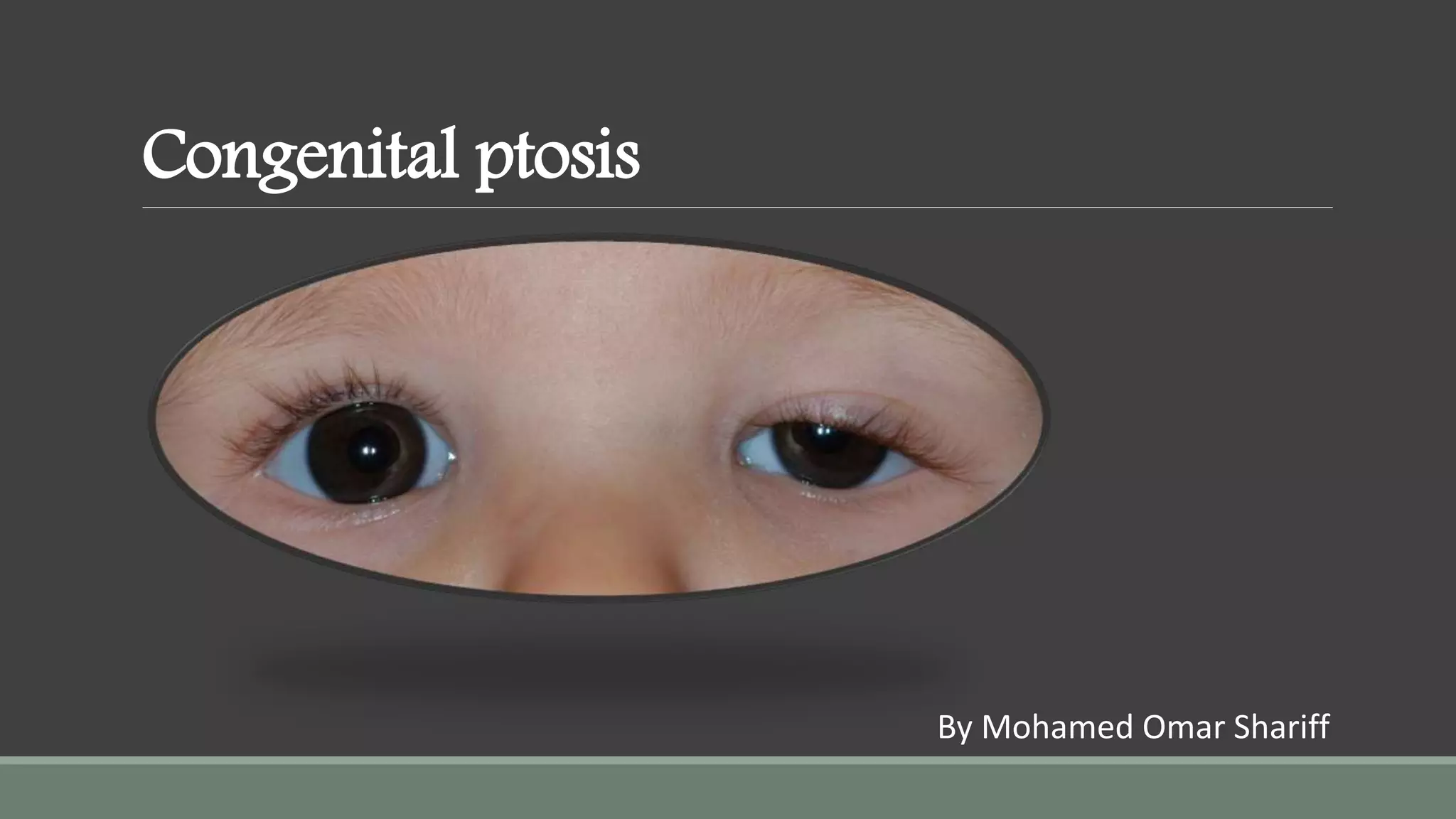 Congenital ptosis | PPTX