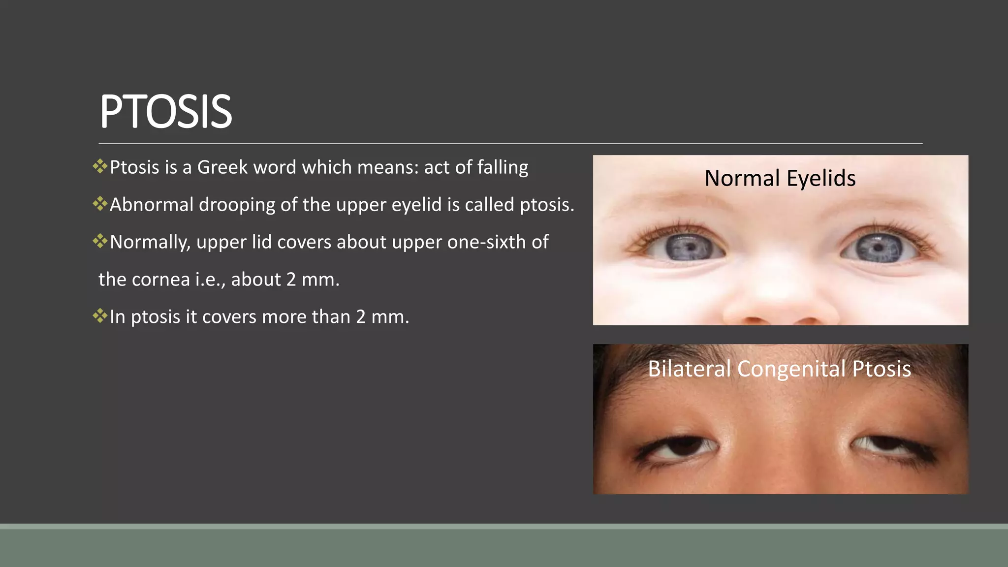 Congenital ptosis | PPTX