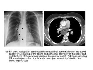 Diagnostic Imaging of Congenital Pulmonary Abnormalities | PPT