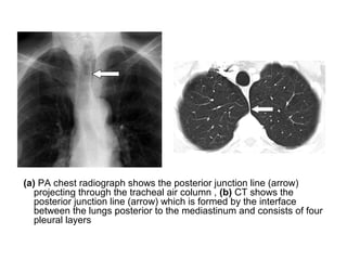 Diagnostic Imaging of Congenital Pulmonary Abnormalities | PPT