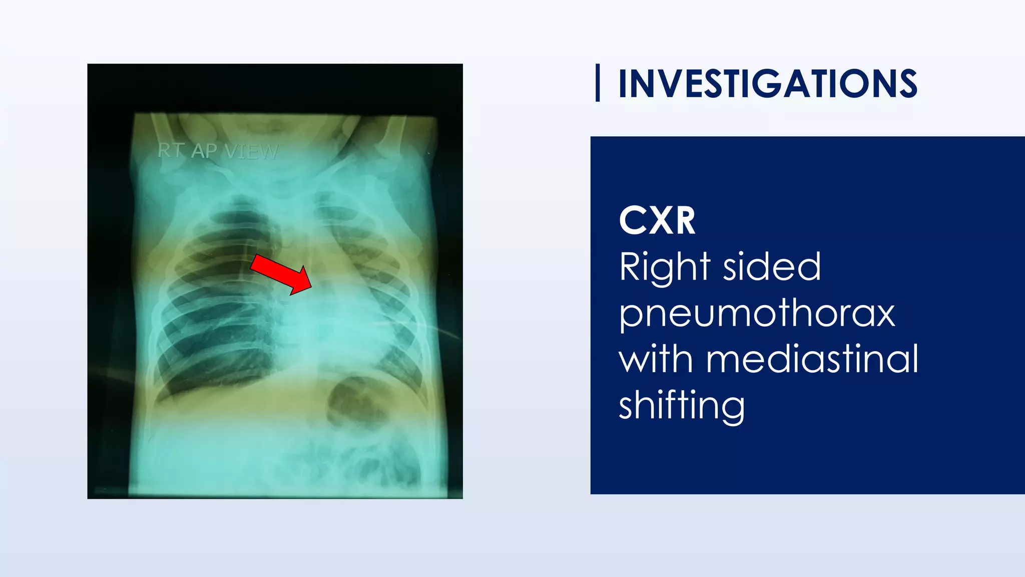 Congenital Lung Malformation Mimics Pneumothorax: An Experience in ...