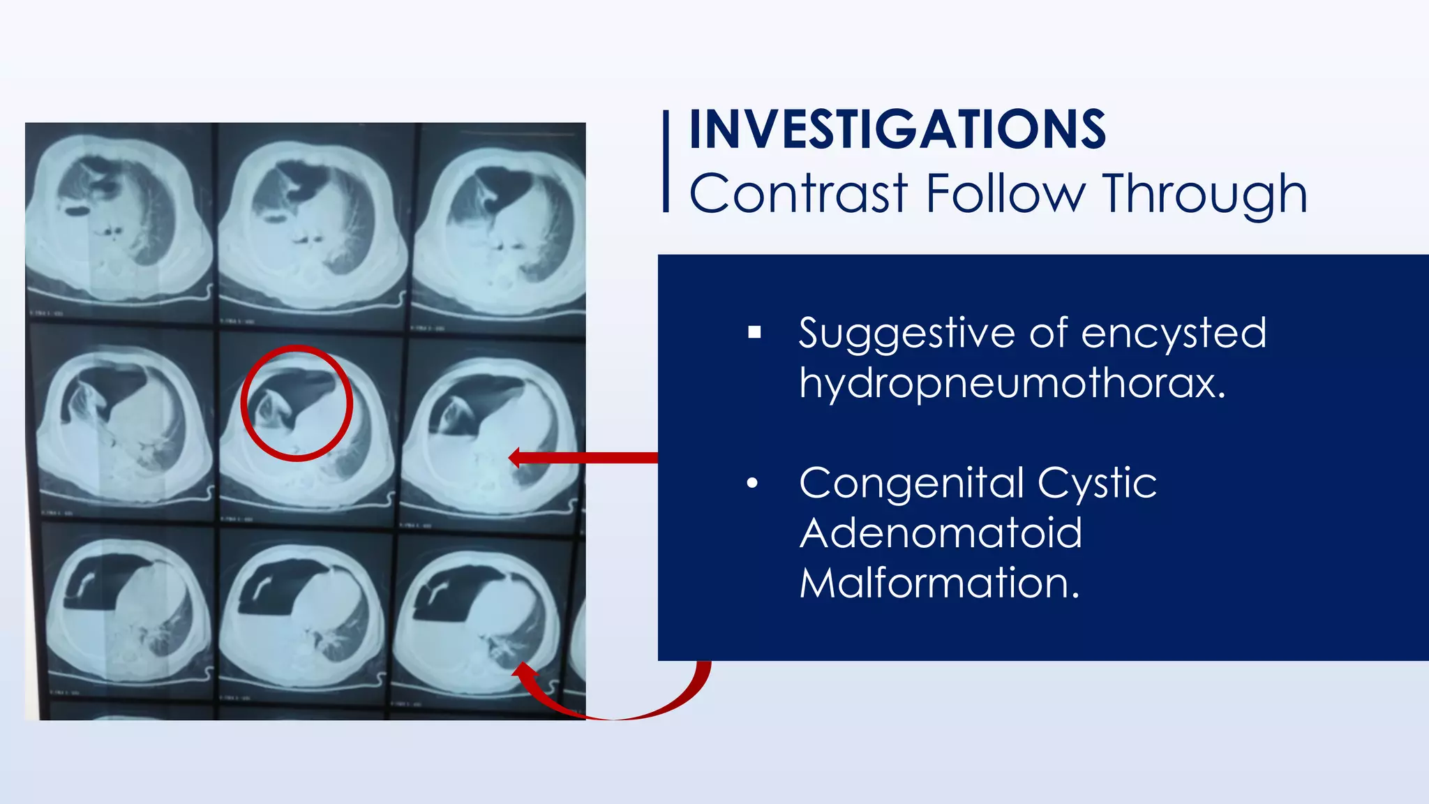 Congenital Lung Malformation Mimics Pneumothorax: An Experience in ...