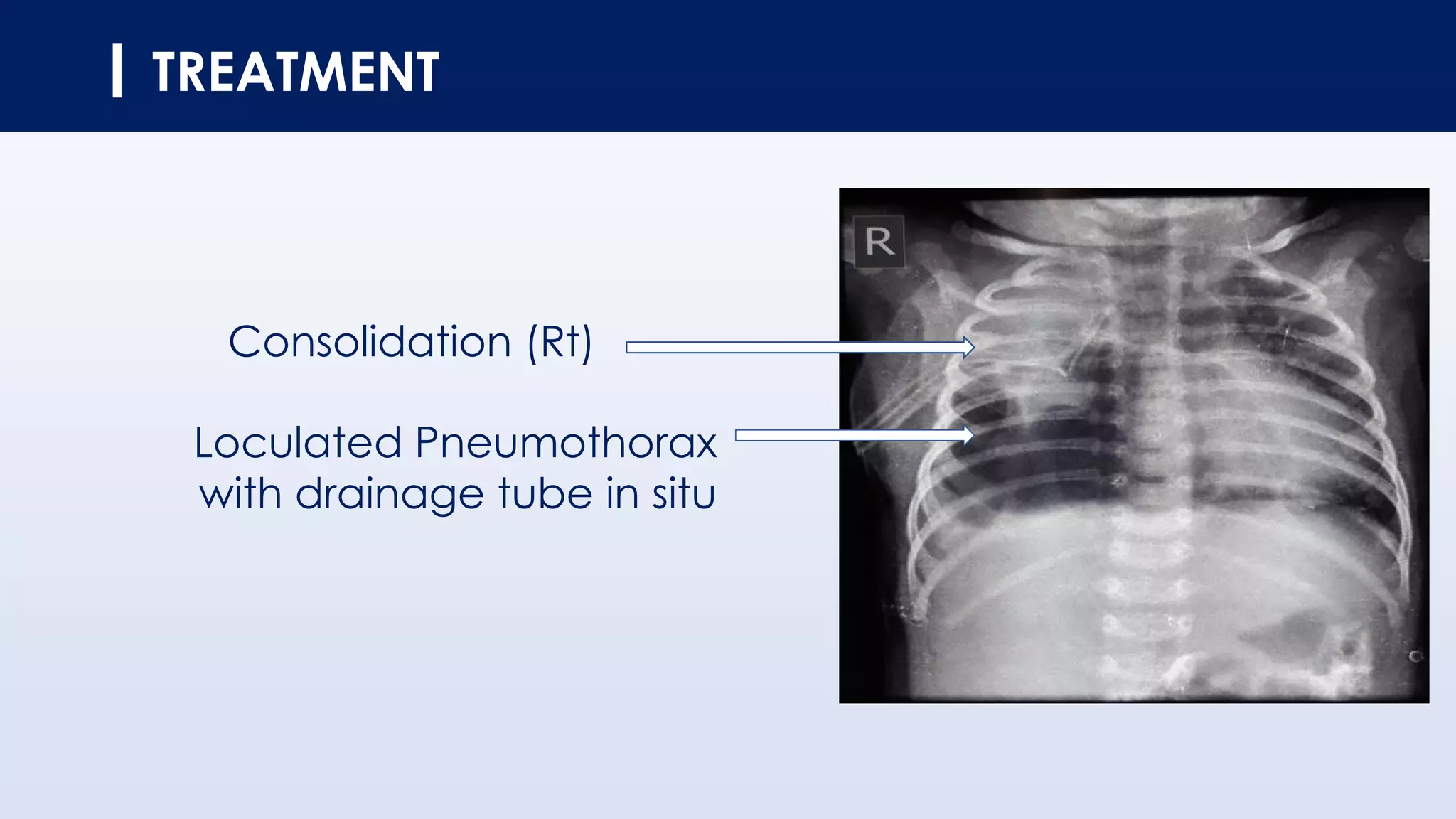 Congenital Lung Malformation Mimics Pneumothorax: An Experience in ...