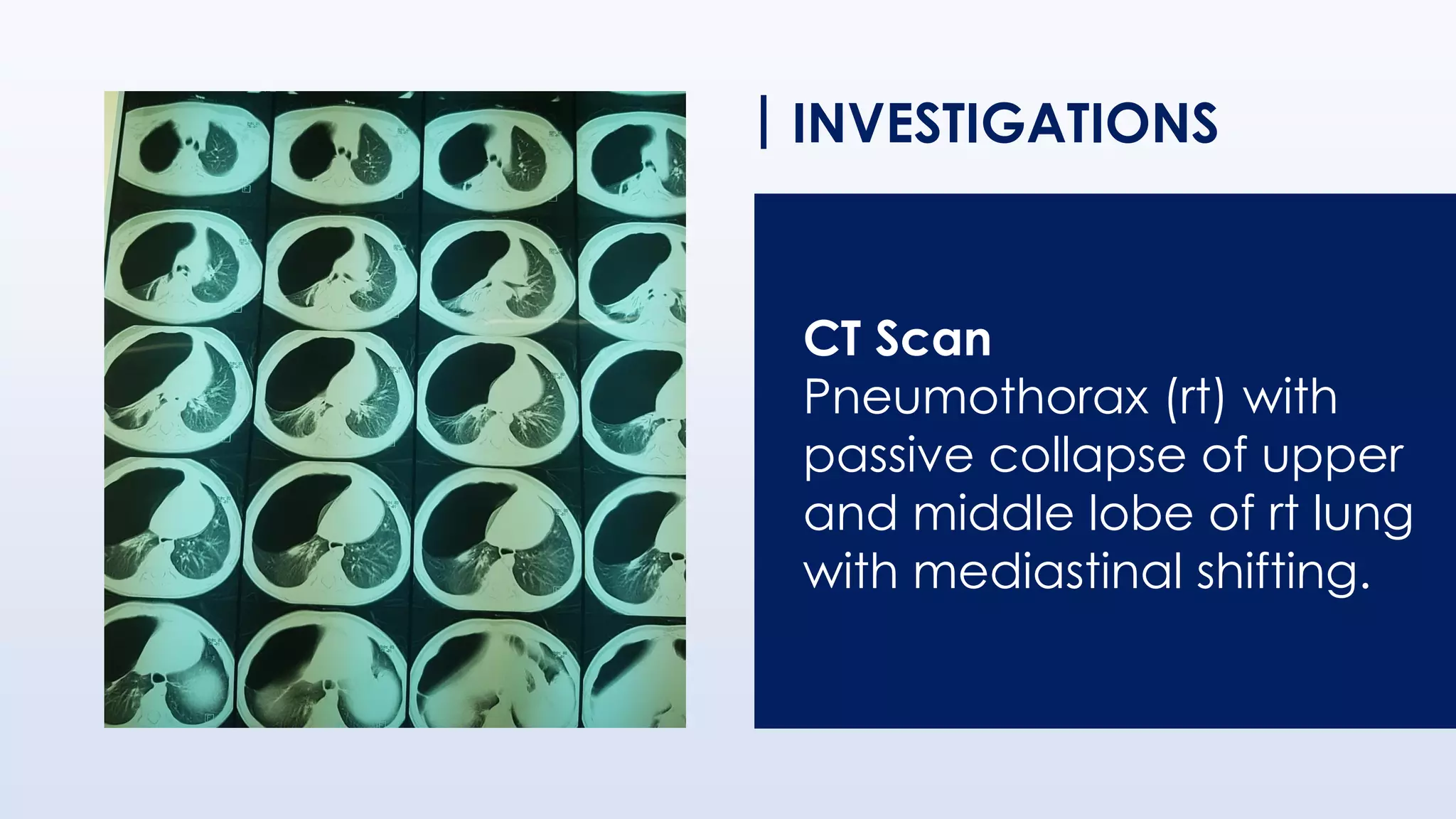 Congenital Lung Malformation Mimics Pneumothorax: An Experience in ...