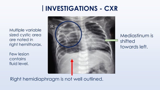 Congenital Lung Malformation Mimics Pneumothorax: An Experience in ...