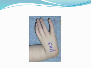 CONGENITAL RADIO-ULNAR SYNOSTOSIS, RADIAL CLUB HAND &.pptx
