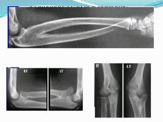 CONGENITAL RADIO-ULNAR SYNOSTOSIS, RADIAL CLUB HAND &.pptx