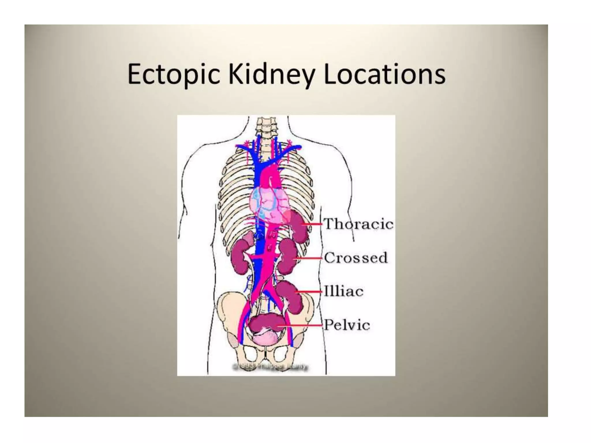 Congenital renal abnormalities in position | PPTX