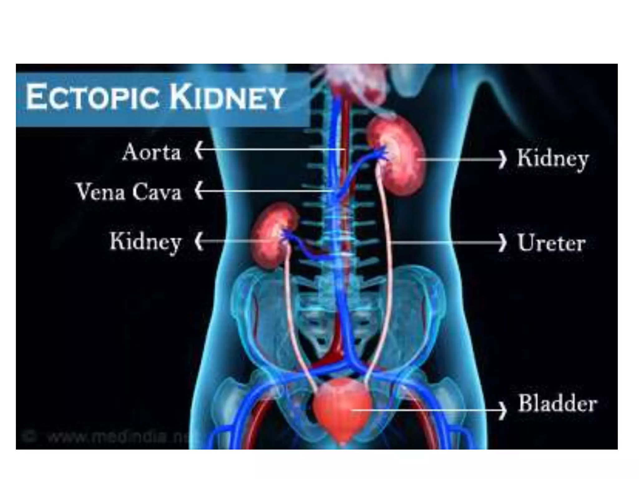 Congenital renal abnormalities in position | PPTX
