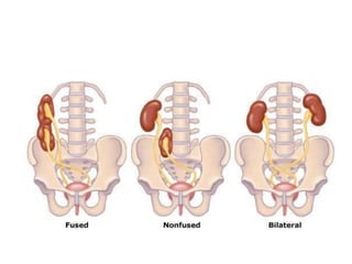 Congenital renal abnormalities in position | PPTX