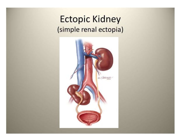 Congenital renal abnormalities in position | PPT