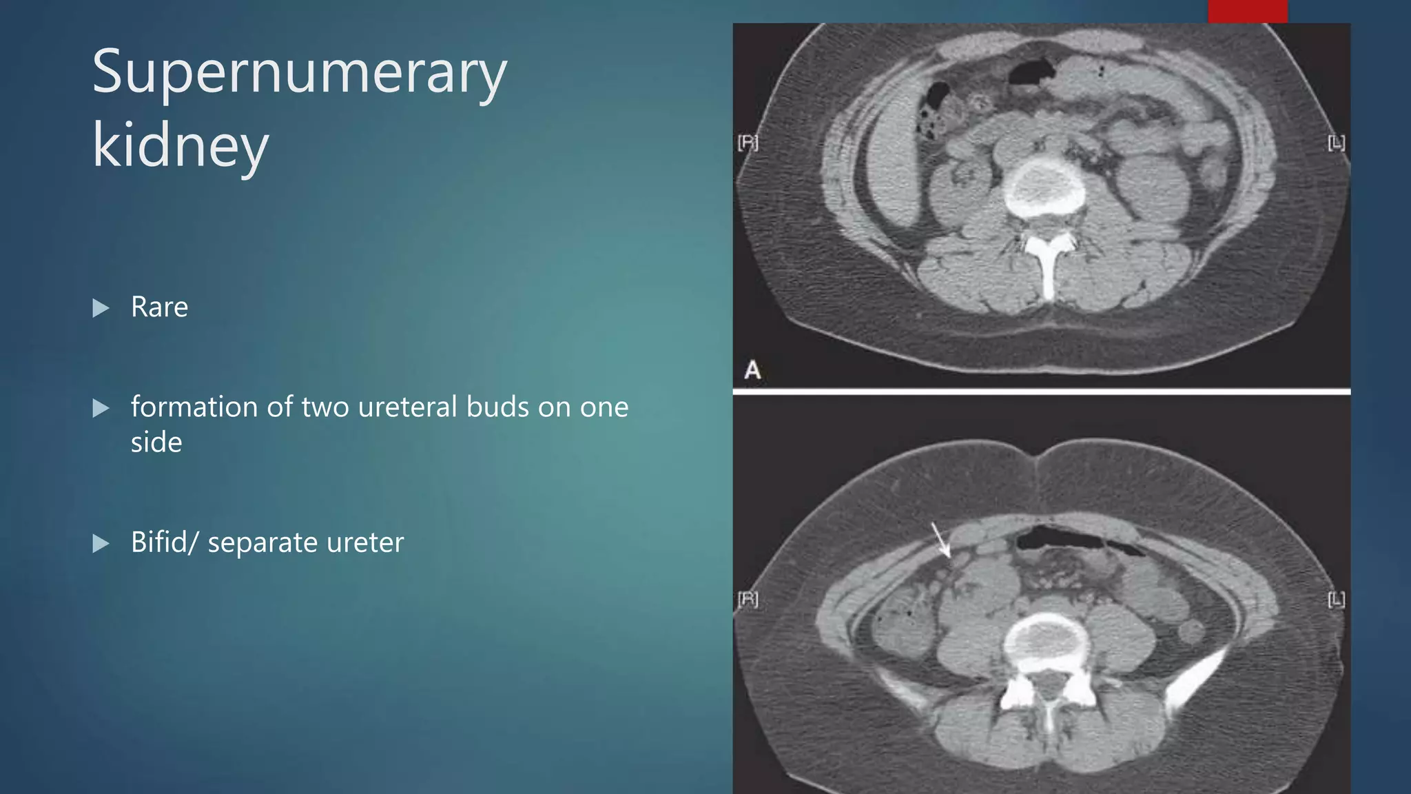Congenital renal anomalies | PPTX