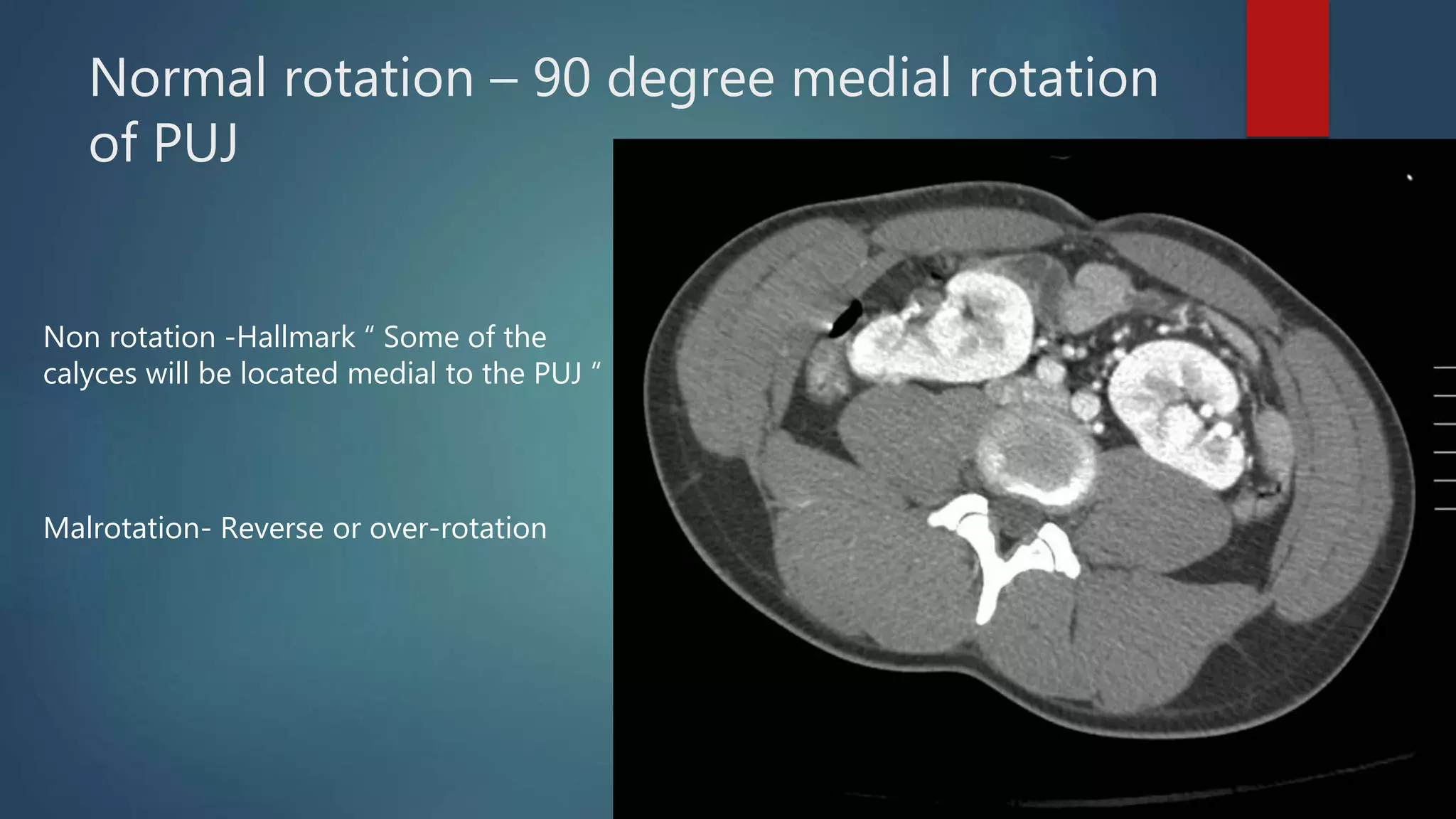 Congenital renal anomalies | PPTX