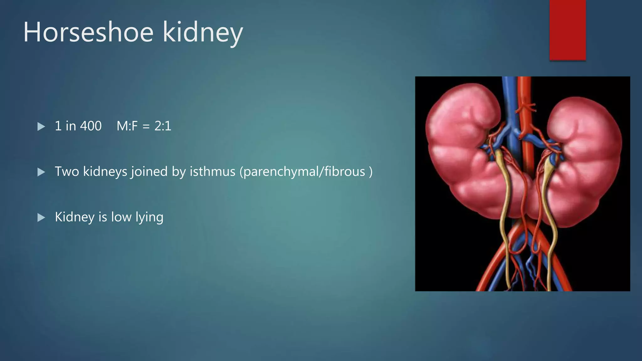 Congenital renal anomalies | PPTX