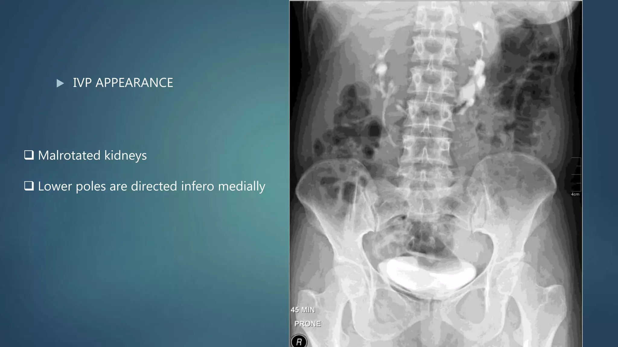 Congenital renal anomalies | PPTX