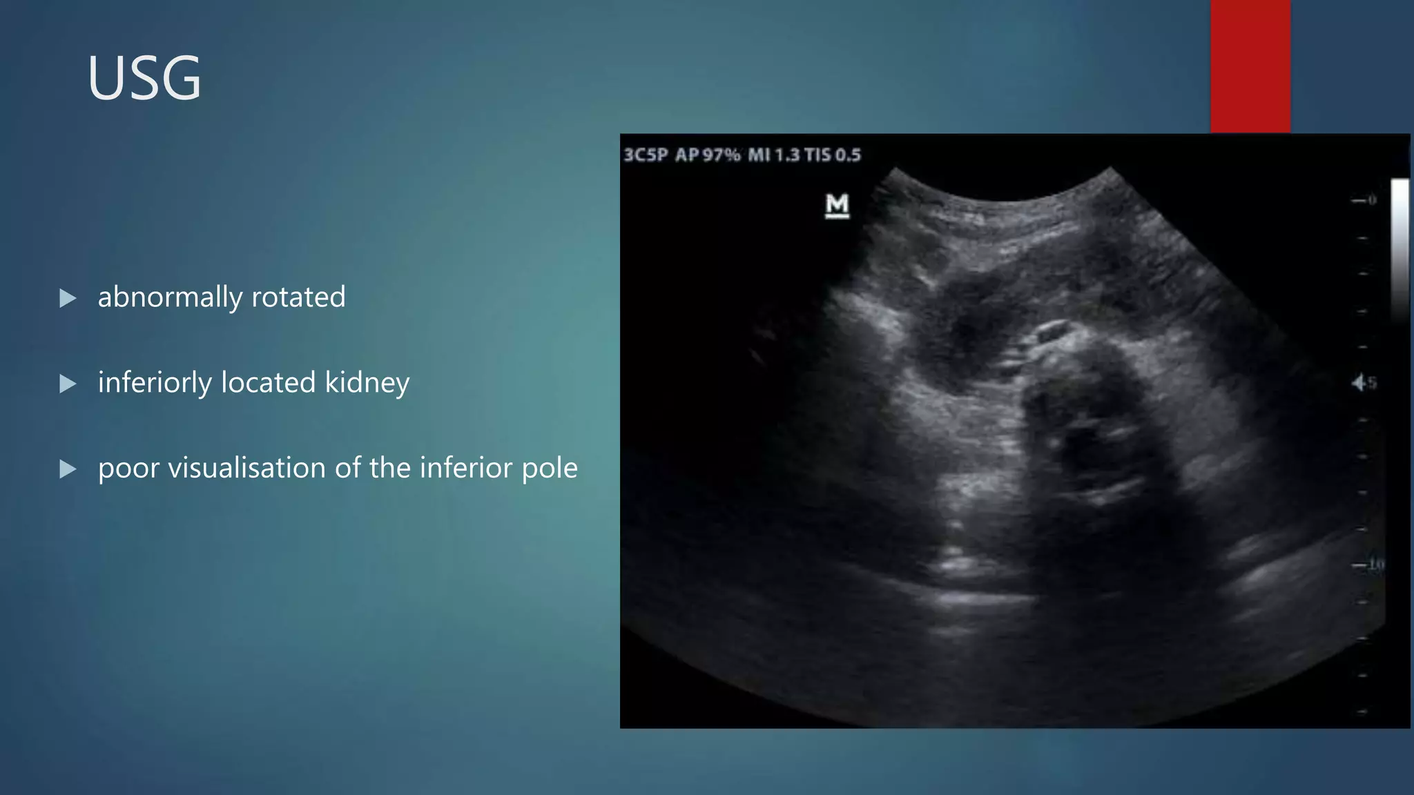 Congenital renal anomalies | PPTX