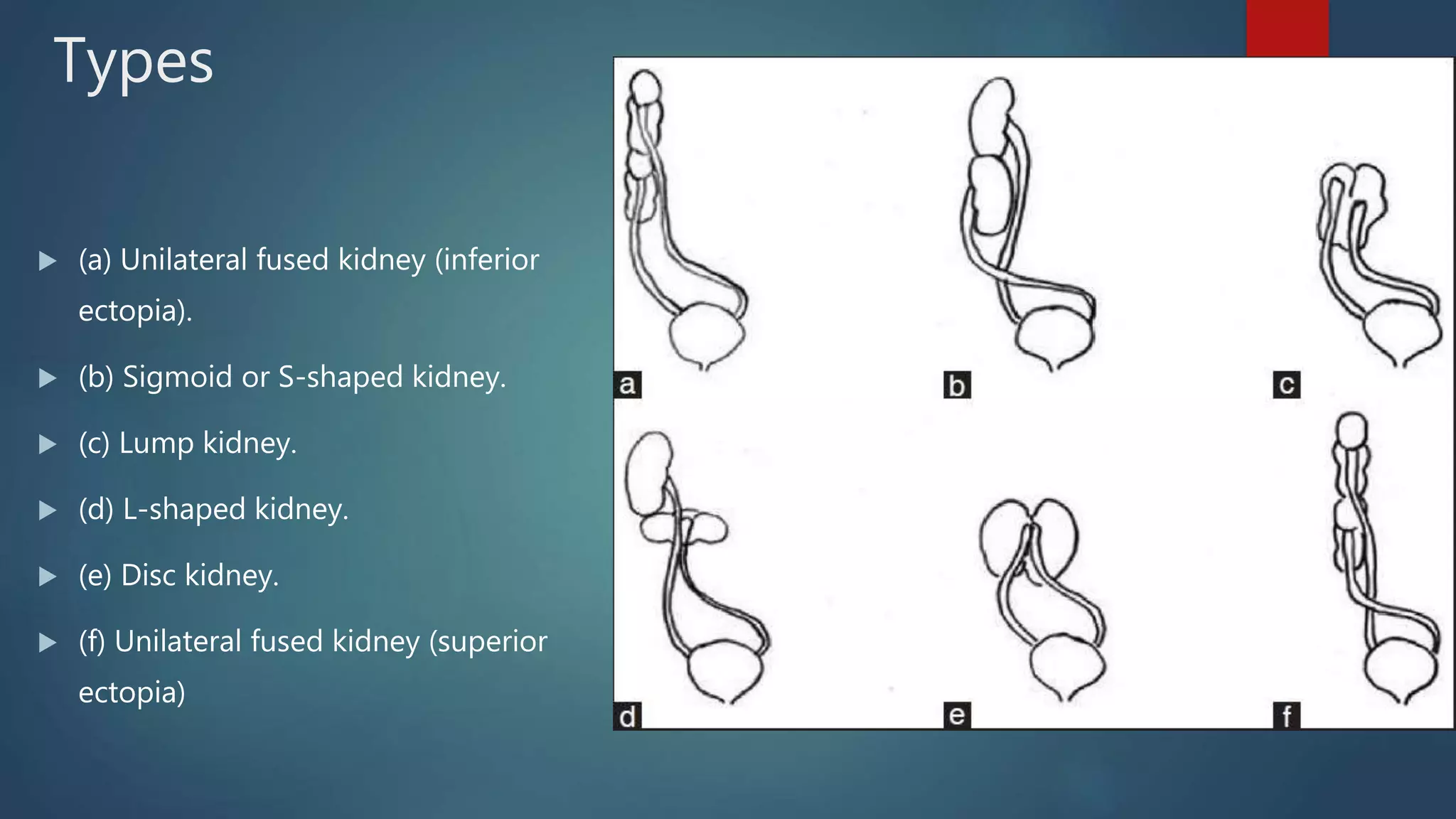 Congenital renal anomalies | PPTX