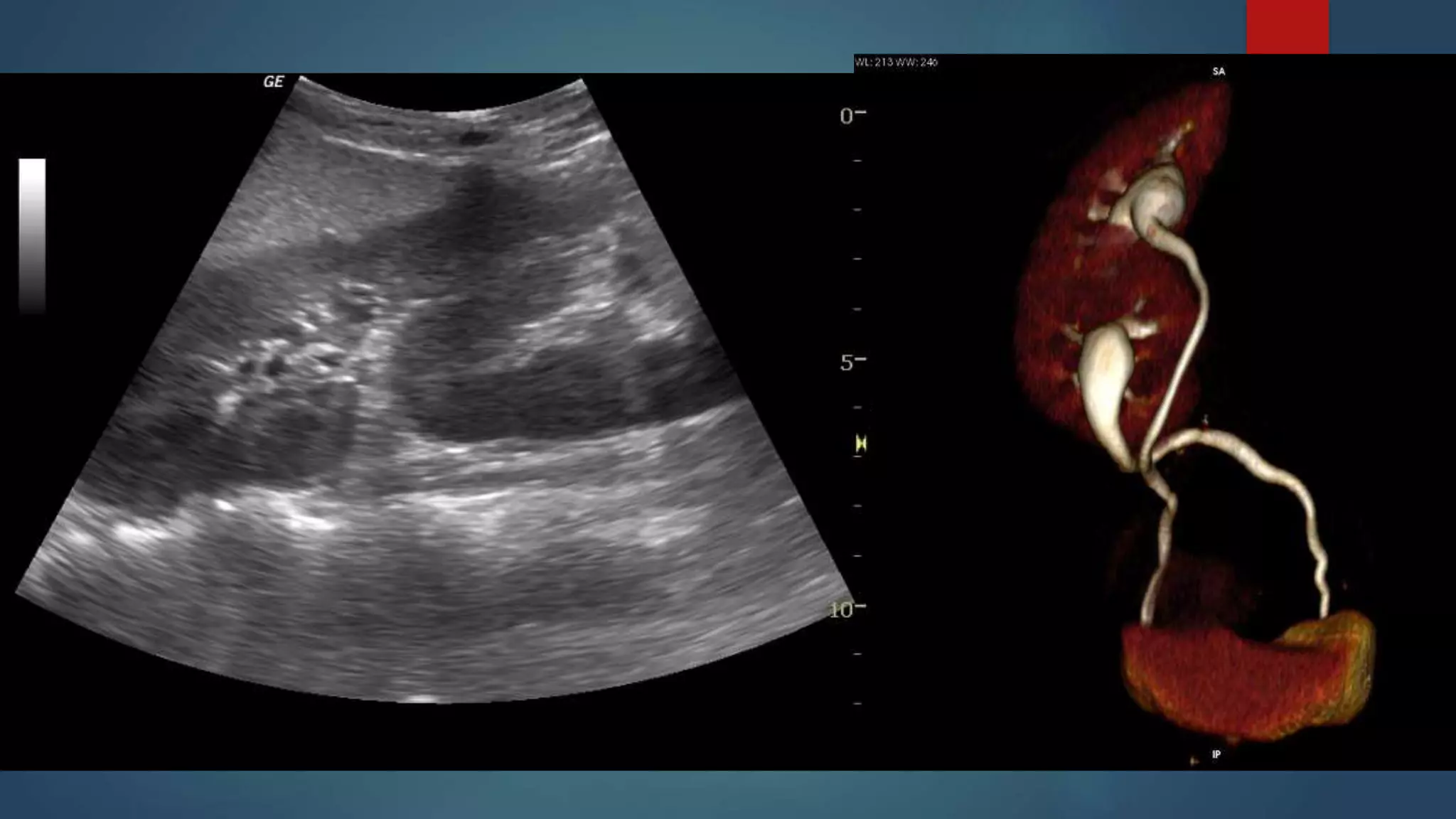 Congenital renal anomalies | PPTX