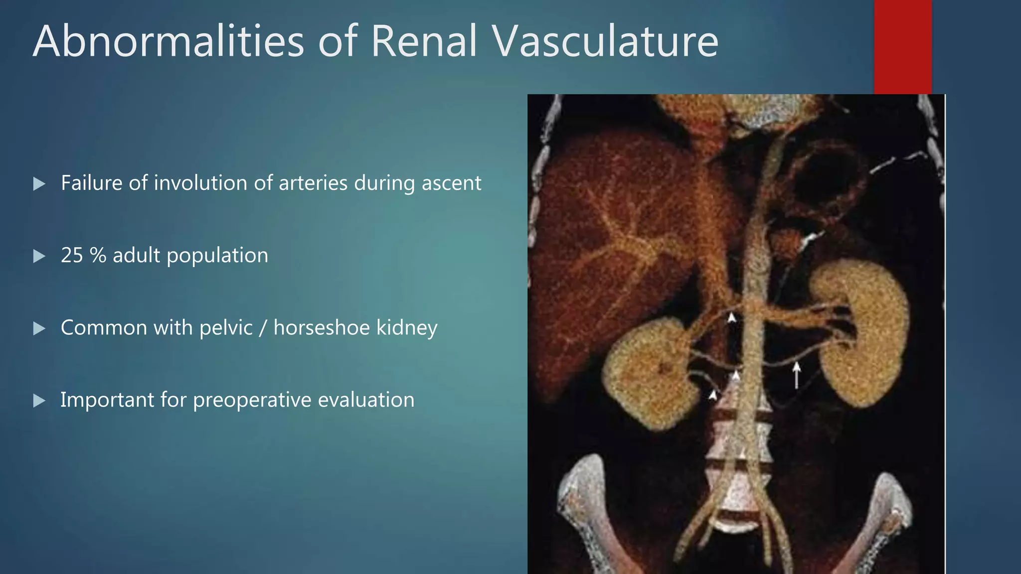 Congenital renal anomalies | PPTX
