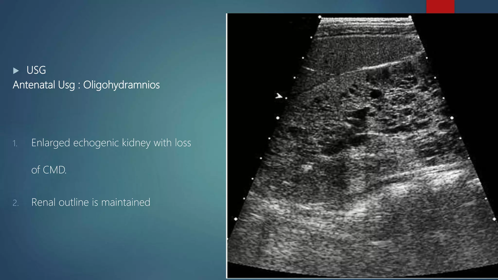 Congenital renal anomalies | PPTX