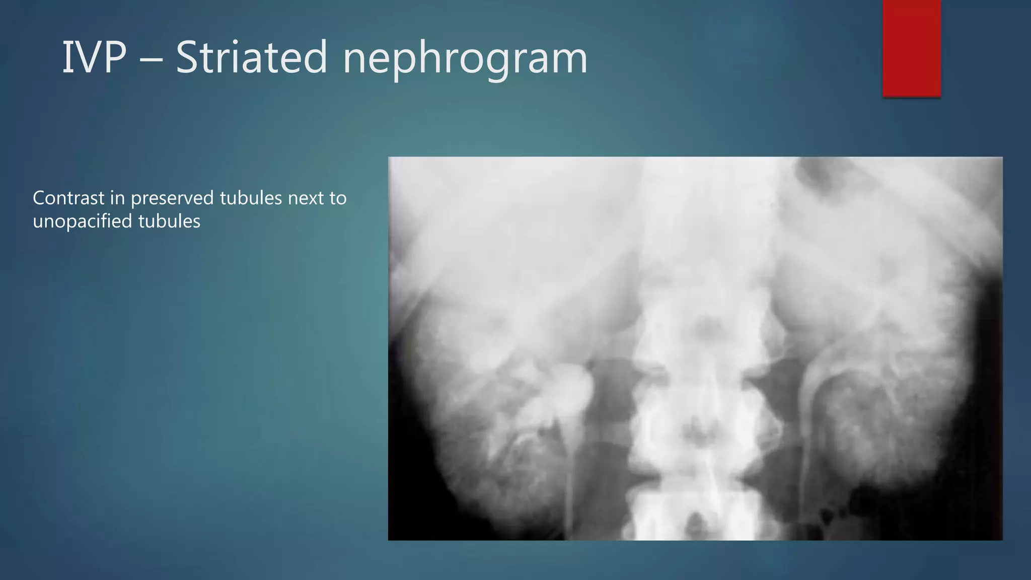 Congenital renal anomalies | PPTX