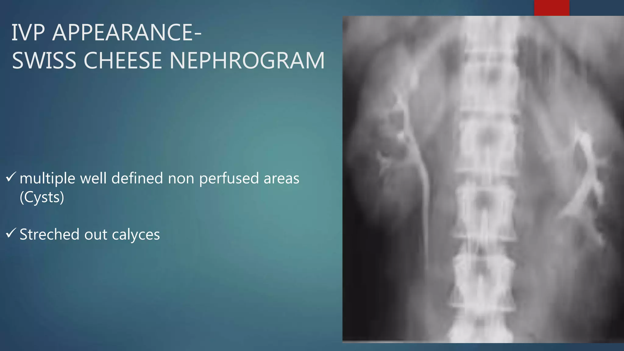 Congenital renal anomalies | PPTX