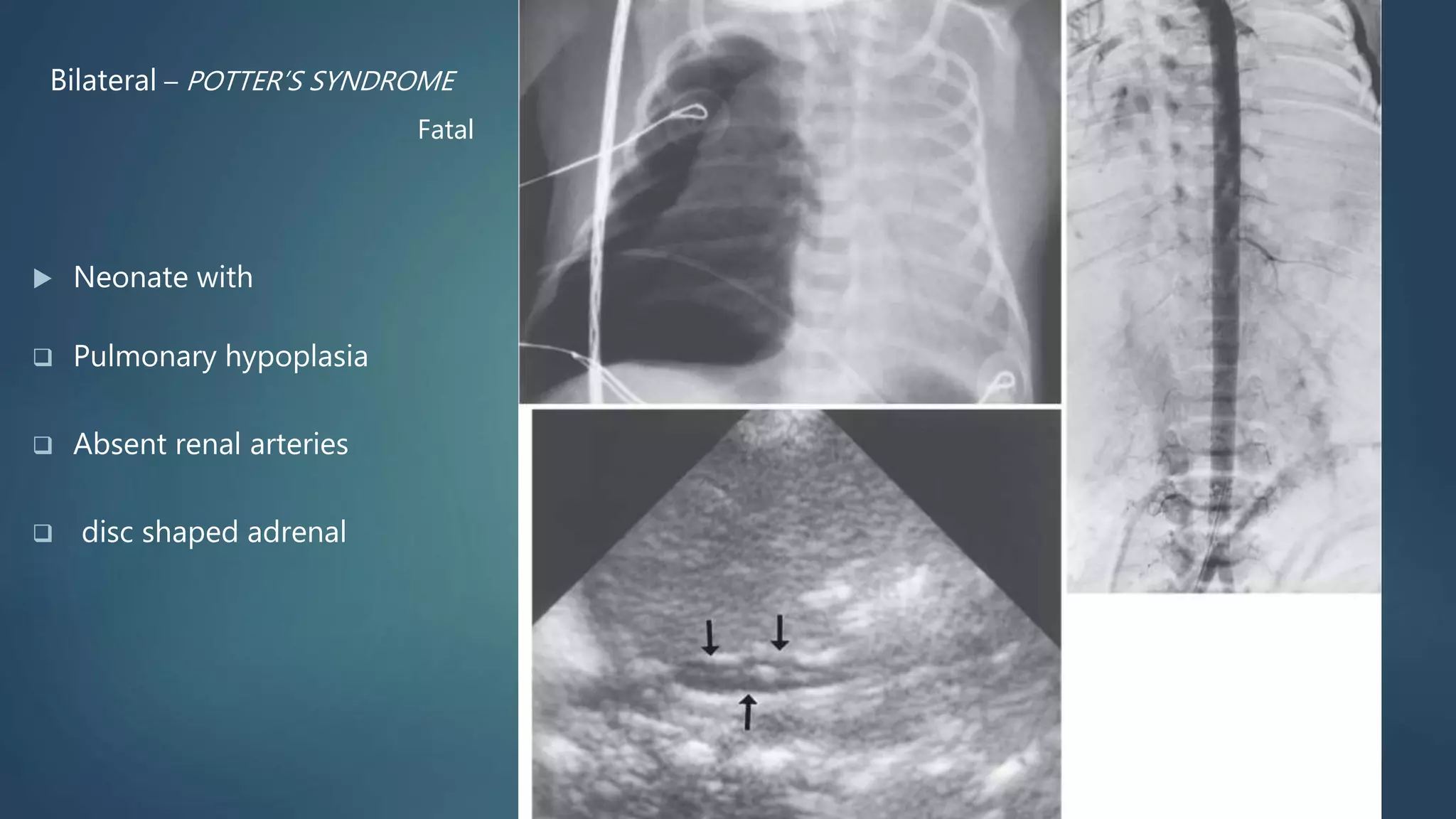 Congenital renal anomalies | PPTX