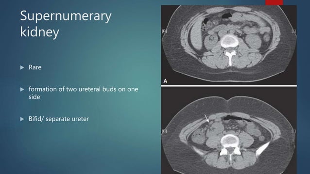 Congenital renal anomalies | PPTX