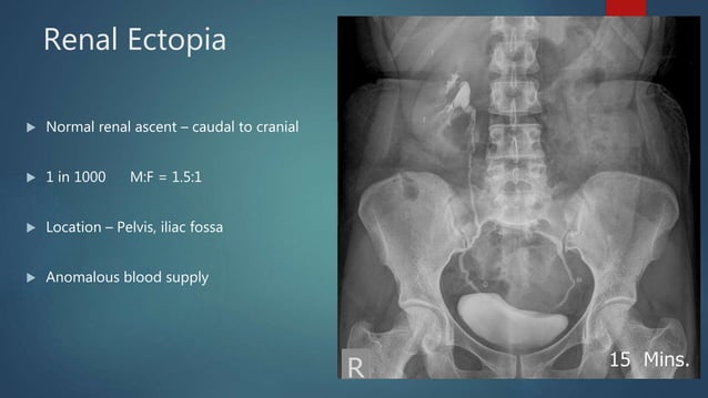 Congenital renal anomalies | PPTX