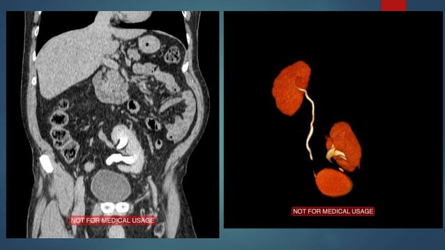 Congenital renal anomalies | PPTX