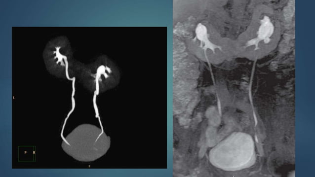 Congenital renal anomalies | PPTX