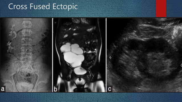 Congenital renal anomalies | PPTX