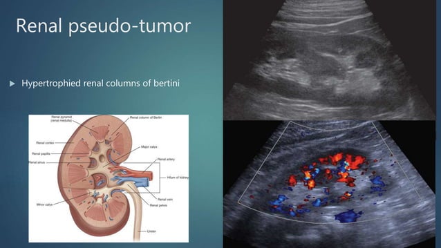 Congenital renal anomalies | PPTX
