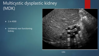 Congenital renal anomalies | PPTX