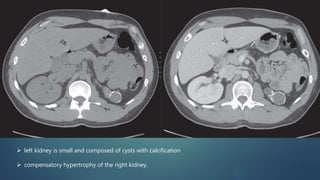 Congenital renal anomalies | PPTX