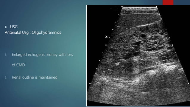 Congenital renal anomalies | PPTX