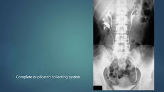 Congenital renal anomalies | PPTX