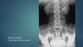 Congenital renal anomalies | PPTX