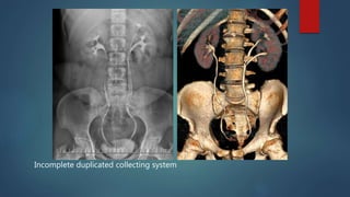 Congenital renal anomalies | PPTX