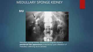 Medullary Sponge Kidney Paintbrush