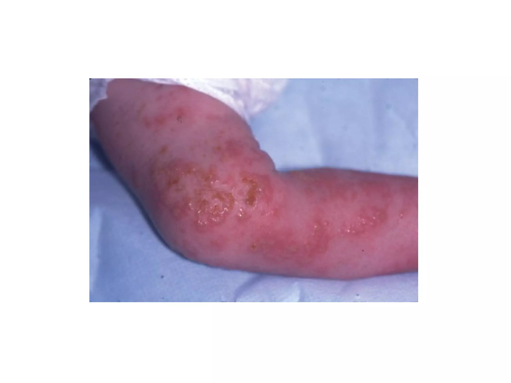 Congenital retinal anomalies | PPT