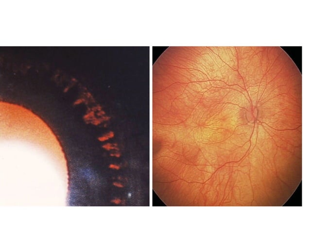 Congenital retinal anomalies | PPT