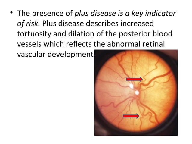Congenital retinal anomalies | PPT