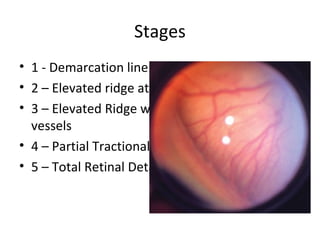 Congenital retinal anomalies | PPT