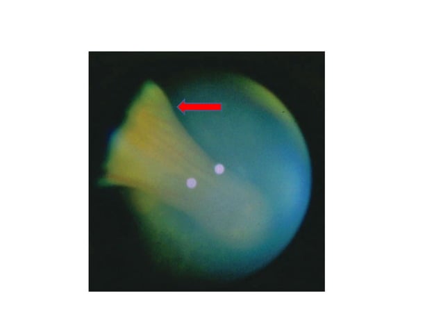 Congenital retinal anomalies | PPT