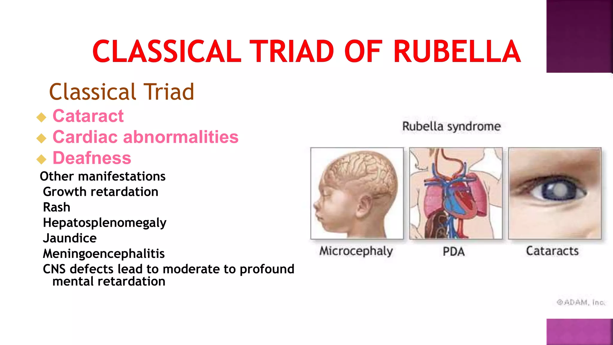 Congenital rubella syndrome | PPTX