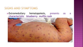 congenitalrubellasyndrome-170330143627 (1).pdf