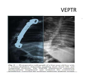 Congenital scoliosis | PPTX