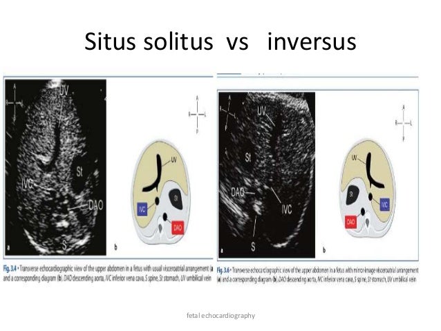 Fetal Echocardiography
