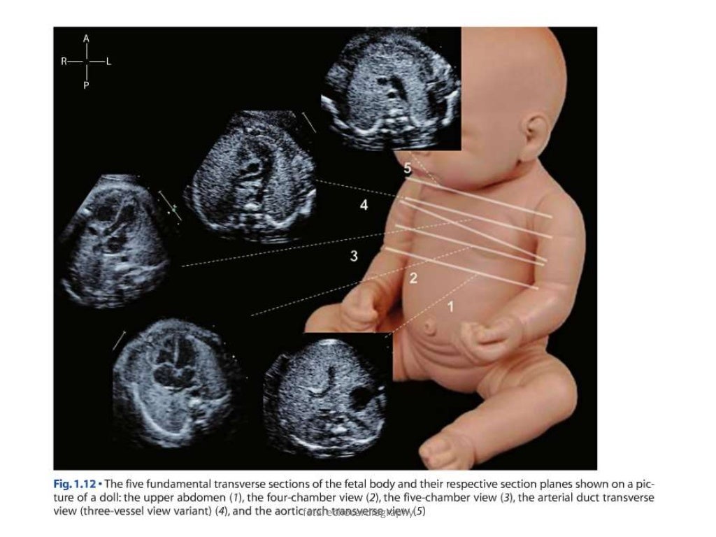 Fetal Echocardiography